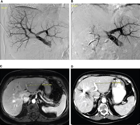 Portal Vein Embolization A Digitally Subtracted Percutaneous Download Scientific Diagram