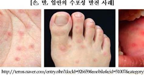 수족구병 환자 1주일만에 또 50 ↑ 영유아 제일 심각