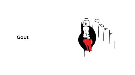 Guide To Gout Causes Symptoms Prevention Healthcare City