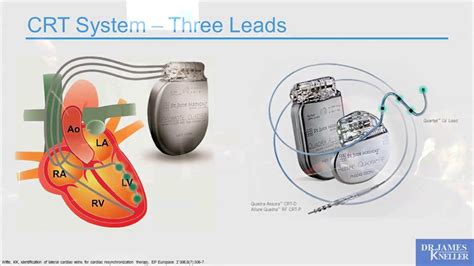 Cardiac Resynchronization Therapy CRT Making Non Response A Non Issue With MultiPoint Pacing