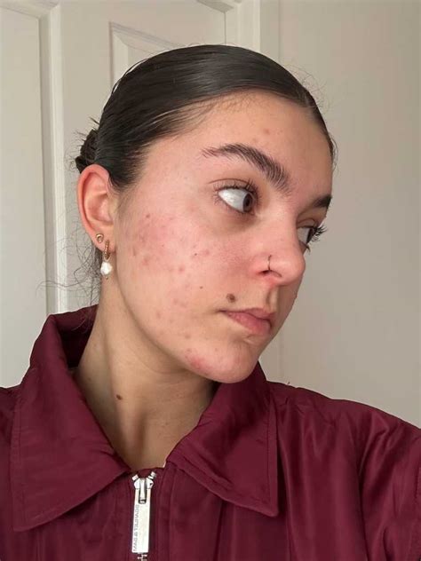 Review The Breakout Hacks Viral Pimple Patches Taking Over Tiktok