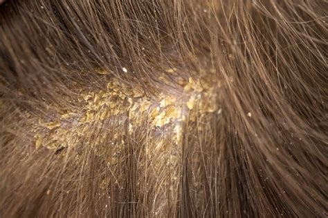 3 Common Scalp Disorders TrichoLab