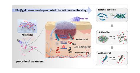 A Conjugated Polymer Based Injectable Hydrogel For Programmed Antibiofilm And Anti Inflammation