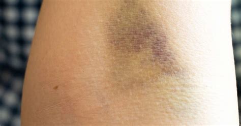 Bruise On Upper Arm