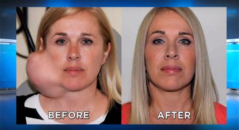 Tumor Removal Before And After