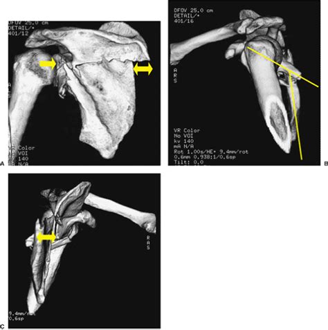 Scapula Fracture Intervention At Ellen Baeza Blog