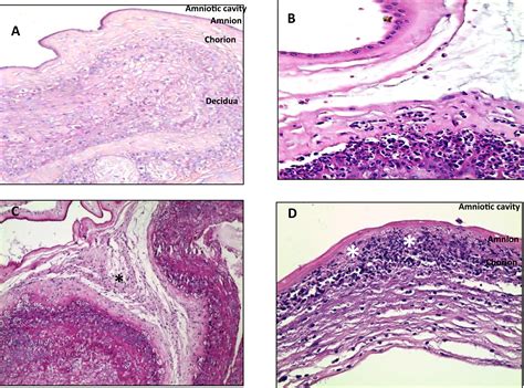 Chorioamnionitis Chorioamnionitis Crash Medical Review Series