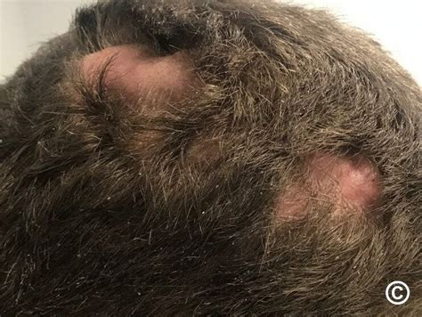 Dissecting Cellulitis