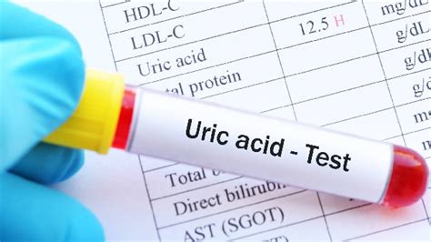 Uric Acid ୟୁରିକ୍ ଏସିଡ୍ ବଢିବାର କାରଣ Reasons For Increase In Uric Acid Odia Oneindia