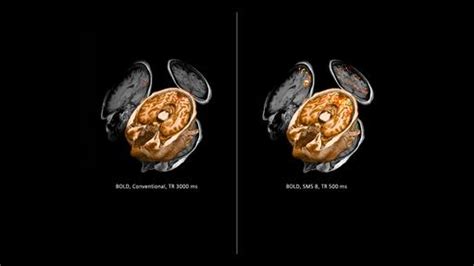 Simultaneous Multi Slice Siemens Healthineers