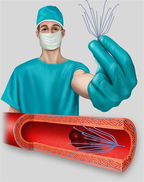 Ivc Filter Lawsuits
