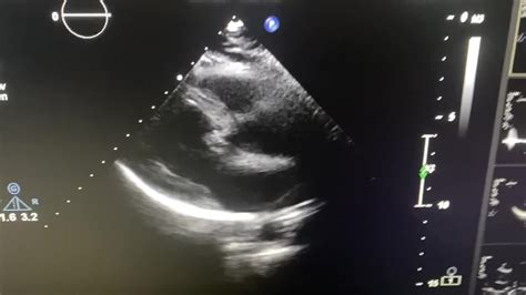 Yanushka Herath On Linkedin Perimembranous Vsd Echo