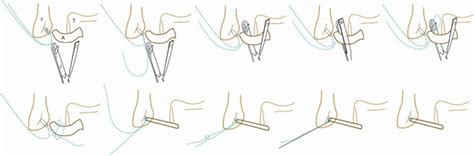 The Use Of A Jaw Designed Suture Passer As Compared To The Lasso Loop