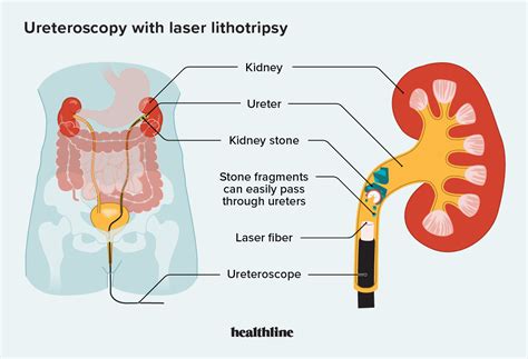 Ureteroscopy Cpt