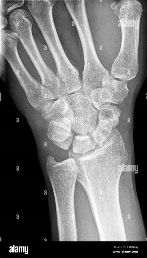 Fractured Scaphoid Wrist Bone With Subchondral Cysts X Ray The