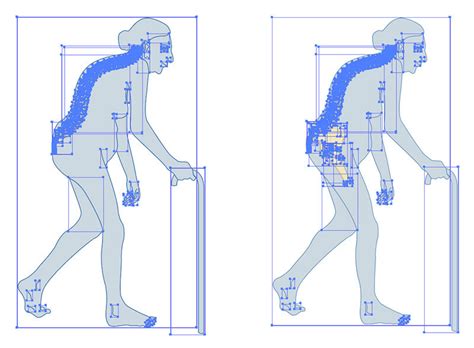 Severe Osteoporosis Vector Scientific Illustration