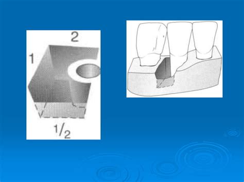 Bone Loss And Patterns Of Bone Lossppt1