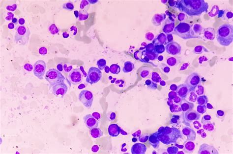 Isatuximab Plus Vrd New Standard For Transplant Ineligible Newly Diagnosed Multiple Myeloma