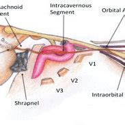 Metallic Artifact Of The Shrapnel In Computed Tomography Download