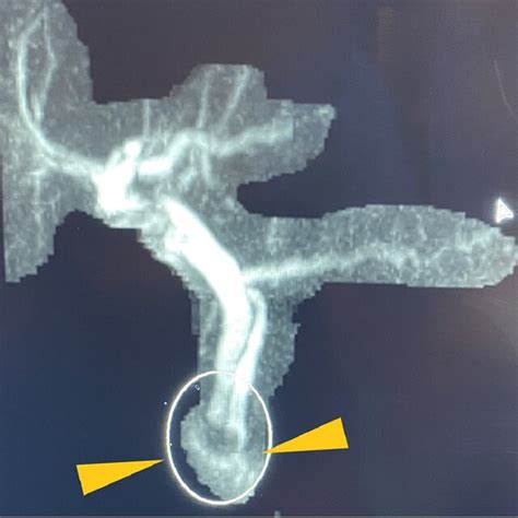 Magnetic Resonance Cholangiopancreatography Mrcp Showed A Suspicious Download Scientific