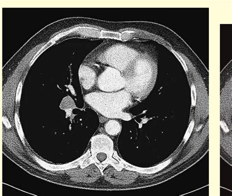 1 La Cross Sectional Ct Scan Of The Thorax Showing A Station