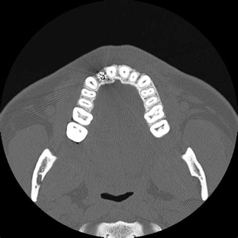 Normal Sinus Ct Annotated Radiopaedia 78917 91810 Axial Bone Window