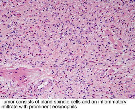 Pathology Outlines Inflammatory Fibroid Polyp