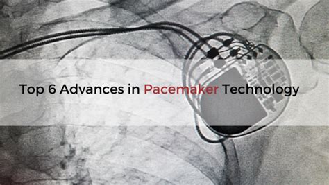Advances In Pacemaker Technology Modern Heart And Vascular
