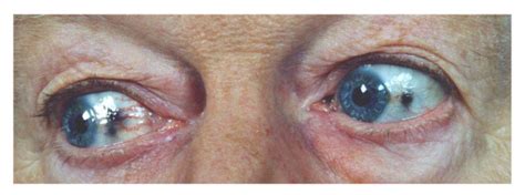 The Darkening Of Sclera