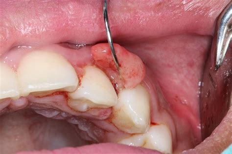Excision Of Oral Lesions Appledore Dental And Implant Centre