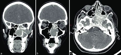 A C A Large Ill Defined Heterogeneously Enhancing Soft Tissue Density Download Scientific