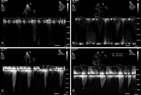 Pulsed Wave Doppler