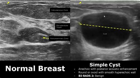 Small Parts Ultrasound Normal Vs Abnormal Images Thyroid Breast Scrotum Testis Eye Usg