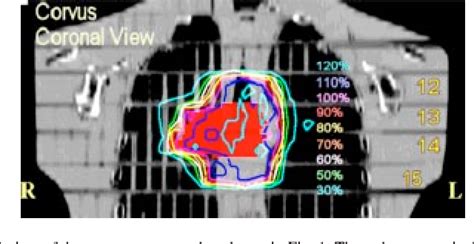 Figure 2 From Dose Calculation Accuracy Of Lung Planning With A Commercial Imrt Treatment
