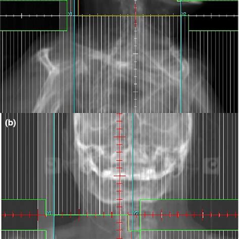 A Digitally Reconstructed Radiograph Drr Illustrating One Beam Download Scientific Diagram
