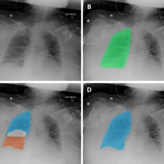 Segmentation With The Stacked Active Contour Model A An Example