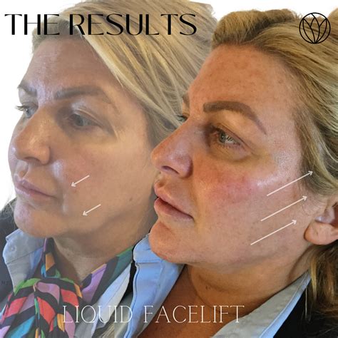 Liquid Facelift Standard The Skin Clinic