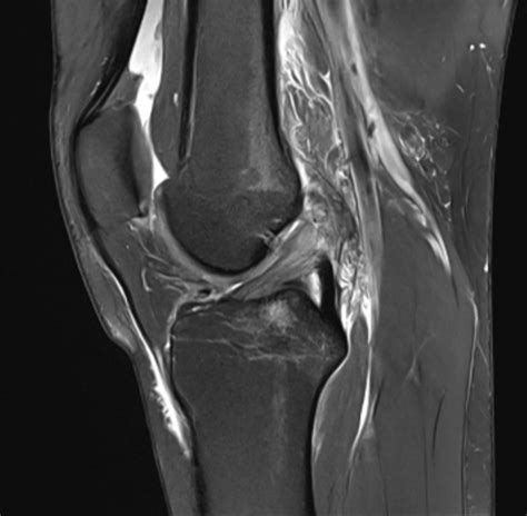 Acl Cross Bracing Protocol Key Patient Selection Factors For Physios — Physio Network