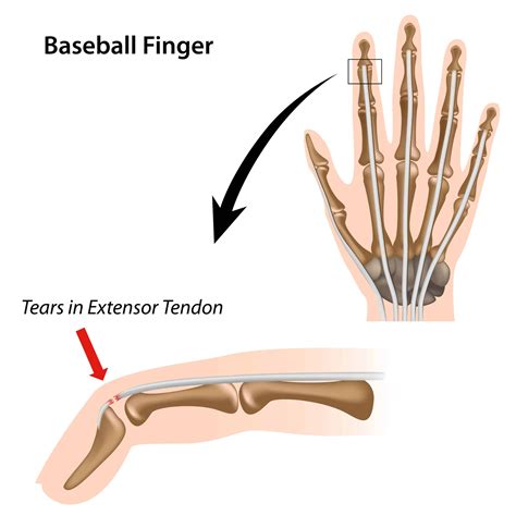 Extensor Tendonitis Hand Extensor Tendon Injury The British Society