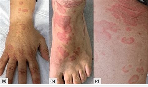 Relapse Of Polycyclic Annular Erythematous Lesions On The Hands A Download Scientific