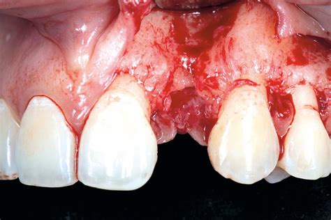 Horizontal Ridge Augmentation Using Cerabone Block Permamem And