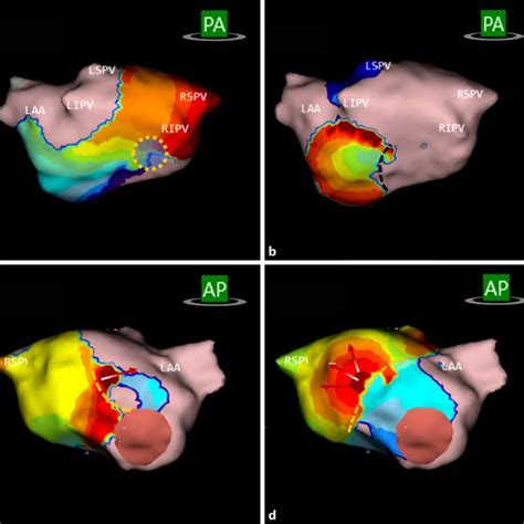 Three Activation Patterns Of Interest In Patient 21 All Panels Show
