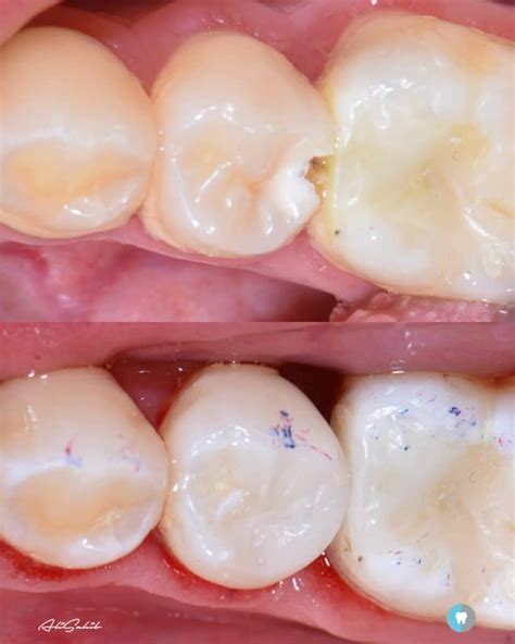 Cervical Margin Reshaping Reducing The Cervical Margin Concavity Or