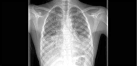 Chest Radiograph Showing Extensive Bilateral Infiltrates Download