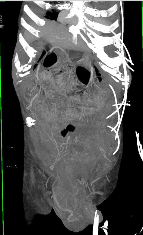 Small Bowel Obstruction Sbo Due To Small Bowel Into A Incarcerated