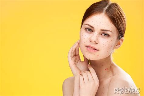 Woman With Bare Shoulders Red Dots On Her Face Health Problems • Wall