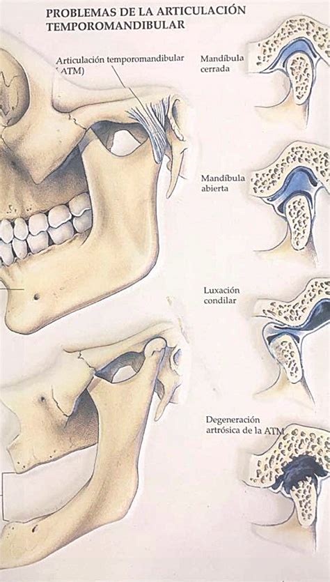 Articulacion Temporomandibular Dolor
