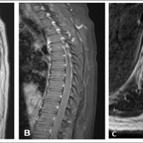 Magnetic Resonance Of Lumbosacral Spine A Sagittal T2 Sequence Shows