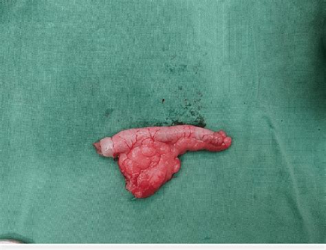 Inflamed Vermiform Appendix Specimen Removed After Appendectomy