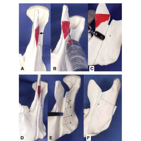 CT Radiograph Showing TMJ Subluxation Download Scientific Diagram